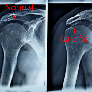Shoulder Calcific Tendinitis – Shockwave Therapy