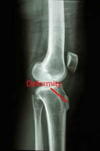 Osgood-Schlatter – Shockwave Therapy