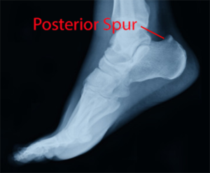 Bony Heel Spur – Shockwave Therapy