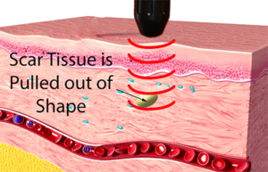 Biological Effects of Radial Shockwave – Shockwave Therapy
