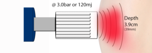 Shockwave Theory – Shockwave Therapy